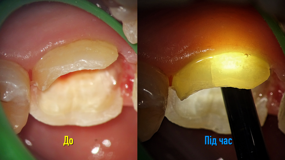 Device for diagnosing tooth cracks LightScaner | MDS