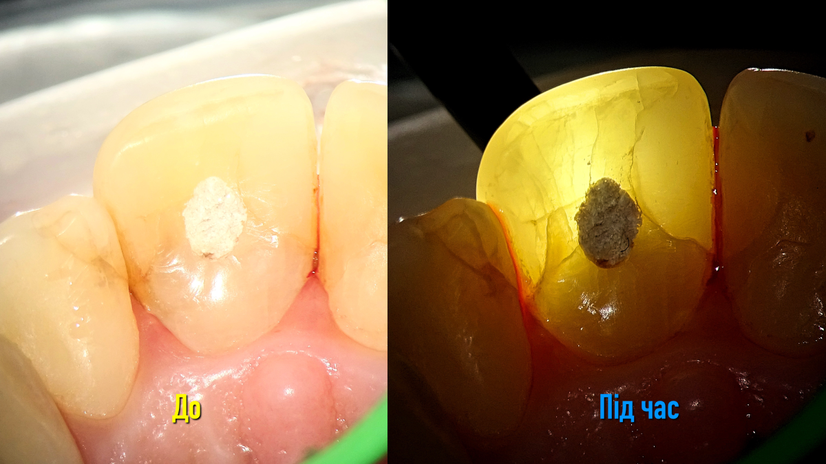Device for diagnosing tooth cracks LightScaner | MDS