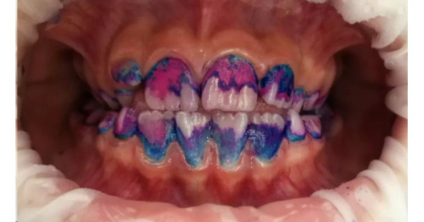 Plaque indicators | MDS